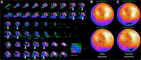Artifacts And Pitfalls In Myocardial Perfusion Imaging Journal Of