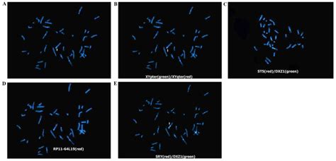 Prenatal Diagnosis Of Sex Chromosomal Inversion Translocation And Deletion