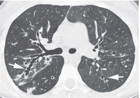 Types Of Bronchiectasis