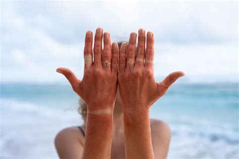 Premium Photo Details Of A Womans Sunburn Skin From The Beach Sun
