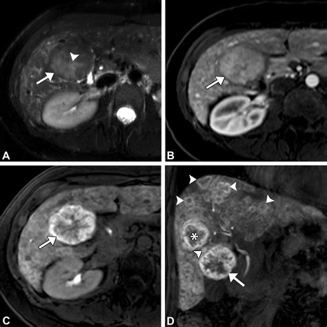 Focal Nodular Hyperplasia And Focal Nodular Hyperplasia Like Lesions