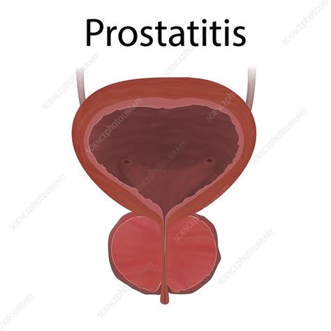 Prostatitis Illustration Stock Image F026 5795 Science Photo Library