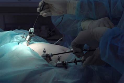 Cystectomies For Bladder Cancer What You Need To Know