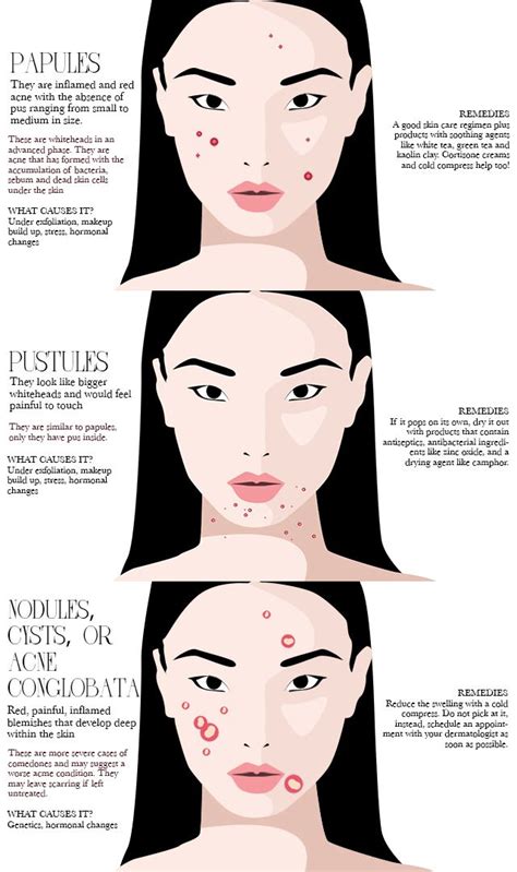 6 Different Types Of Acne Explained Beauty Bay Edited