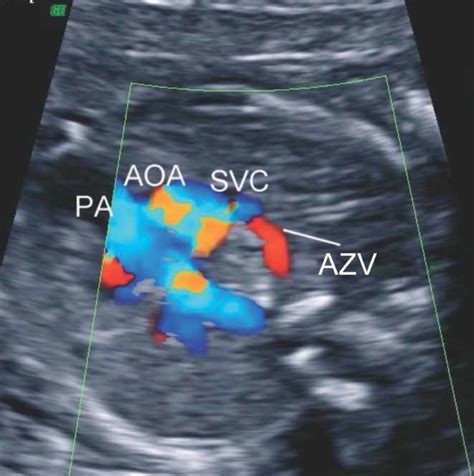 Subclavian Artery Ultrasound
