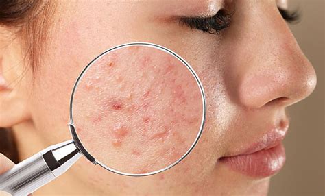 Fungal Acne Vs Closed Comedones
