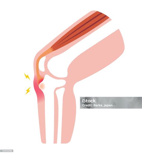Ilustración De Osgoodschlatter Y Más Vectores Libres De Derechos De