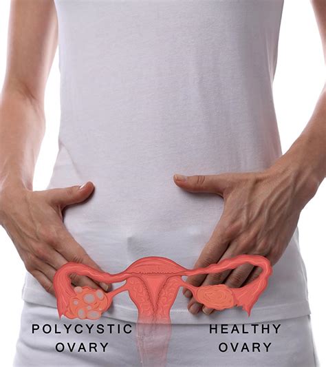 17 Home Remedies To Treat Pcos Prevention Tips