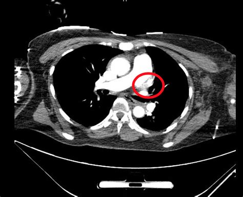 Cureus Lethal Pulmonary Embolism Following Left Upper Extremity