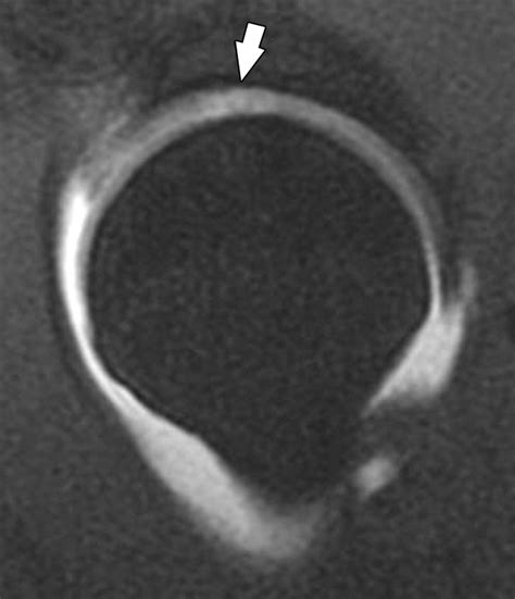 Mr Arthrography Of The Hip Comparison Of Ideal Spgr Volume Sequence To