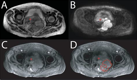 Prognostic Value Of Preoperative Dynamic Contrast Enhanced Magnetic