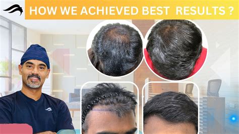 Hair Transplant In Dubai Best Results Cost Surgeon And Clinic Of Hair
