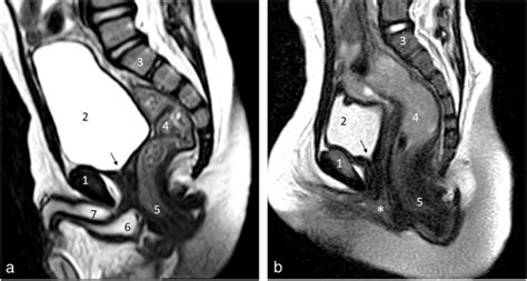 Transformation Of The Female Genitalia In Congenital Adrenal