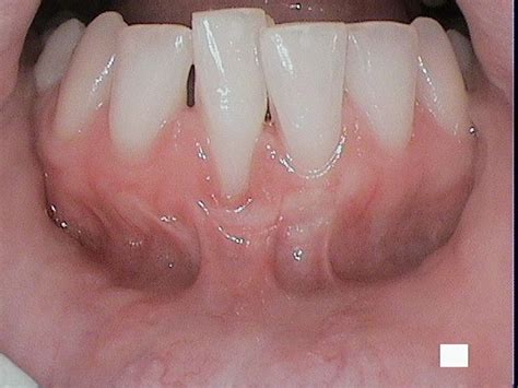 Dr Denine Rice Rice Laser Periodontics And Implant Surgery Laser