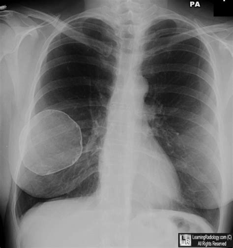 Learningradiology Saline Breast Implant Calcification