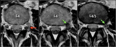 The Radiology Assistant Spine Lumbar Disc Herniation
