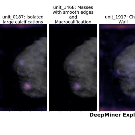 Illustration Of The Deepminer Framework For Mammogram Classification