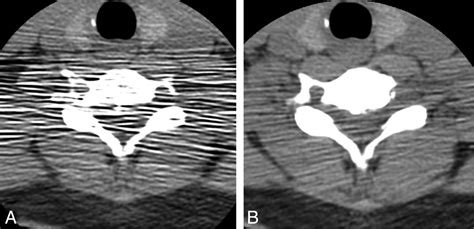effect of the ct table strap on radiation exposure and image quality