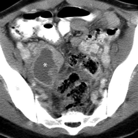 Tubo Ovarian Abscess Contrast Enhanced Computed Tomography Image From