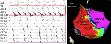 Recipient Atrial Tachycardia With Variable Conduction To Donor