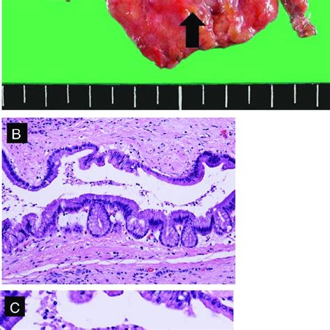Histopathological Findings A The Resected Specimen Showed Dilatation