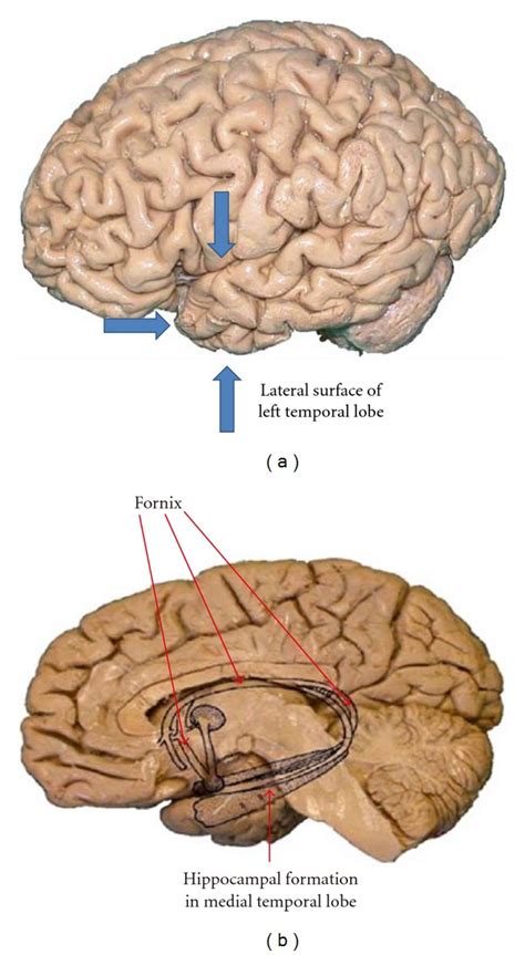Mesial Temporal Lobe Anatomy
