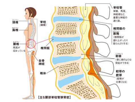 脊柱管狭窄症って何？ 「私ってもう年なのかな…？」と日々のデスクワークから起こる腰痛持ちの40代ol必見！お風呂上りのたった5分の