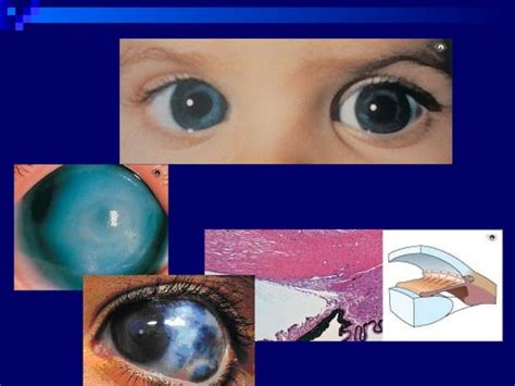 Presión Intraocular Y Glaucoma Ppt