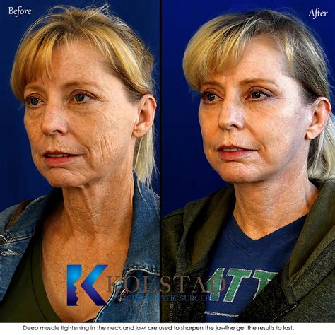 Facelift Before And After Gallery 4 Dr Kolstad San Diego Facial