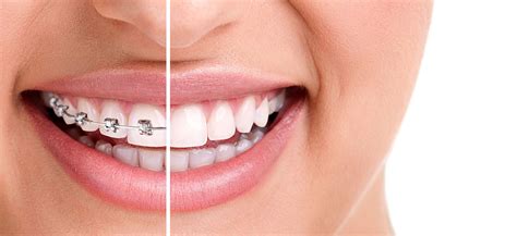 Braces Vs Invisalign Essential Dental