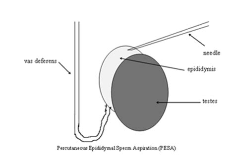 Sperm Retrieval From Vas Deferens Or Epididymis Pesa – Information For
