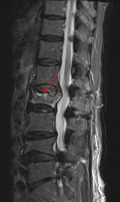 Osteoporosis And Spinal Fractures Orthoinfo Aaos
