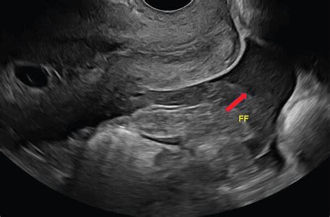 Sagittal Transvaginal Ultrasound Image Of The Cervix With The Posterior