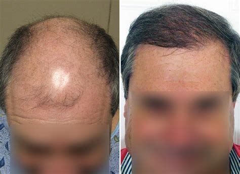Male Fut Hair Transplant Cova Hair