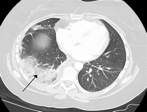 Infark Paru Patofisiologi Diagnosis Penatalaksanaan Alomedika