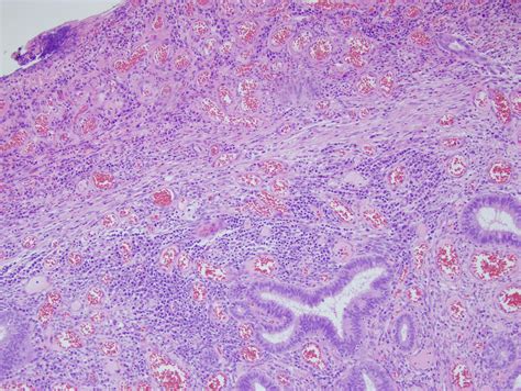 Rectal Polyp Histology