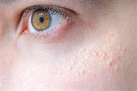 目の下の白いぶつぶつの正体は稗粒腫！【皮膚科治療の体験談】 美quick