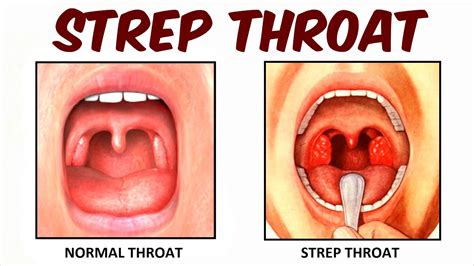 Strep Throat – Telegraph