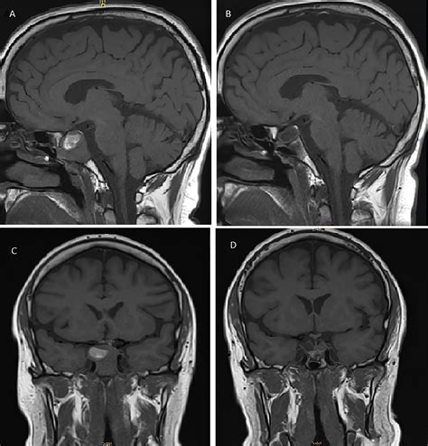 Frontiers Aggressive Pituitary Macroadenoma Treated With Capecitabine