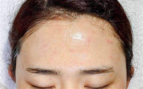 おでこの大人ニキビの原因and解決方法とは。 三ノ輪駅から徒歩圏内にあるエステ・自然の仕上がりのマツエクサロンのブログです