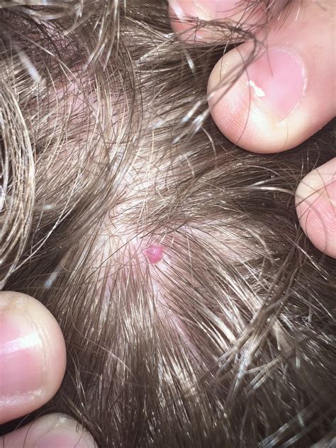 What Is This Bump On My Scalp 20 M R Medical