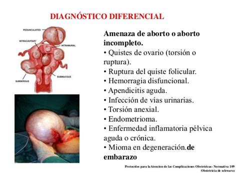 Embarazo Ectopico