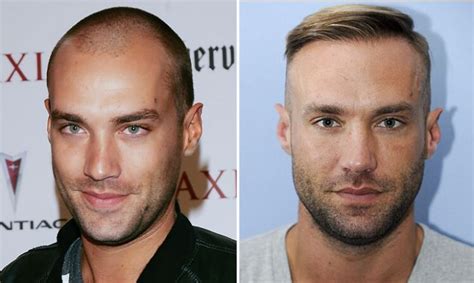 Celebrity Hair Transplant Before And After