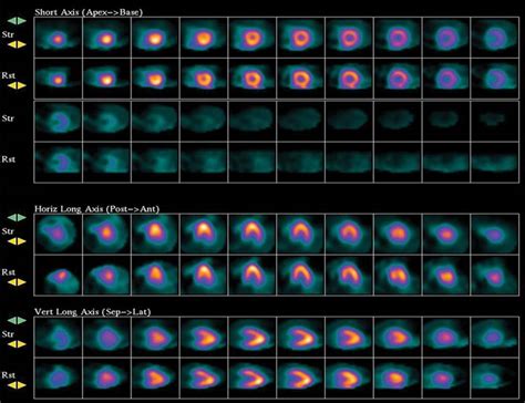 32 Normal Spect Radiology Key