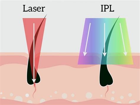 Ultimate Guide To Laser Hair Removal Setsuko Beauty Clinic