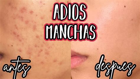 CÓmo Eliminar Las Manchas Del AcnÉ Los Mejores Tips Y Productos Esto