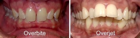 What Is Overjet Symptoms Diagnosis And Orthodontic Treatment