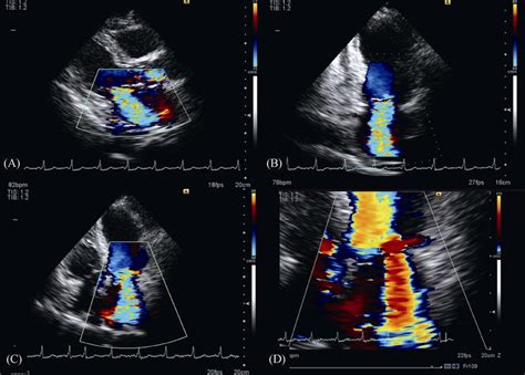 Mitral Valve Echocardiography