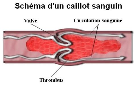 Embolie Pulmonaire Symptômes Causes Traitements Signes Durée