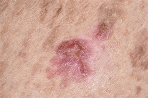 Seborrhoische Keratose Bilder Science Photo Library